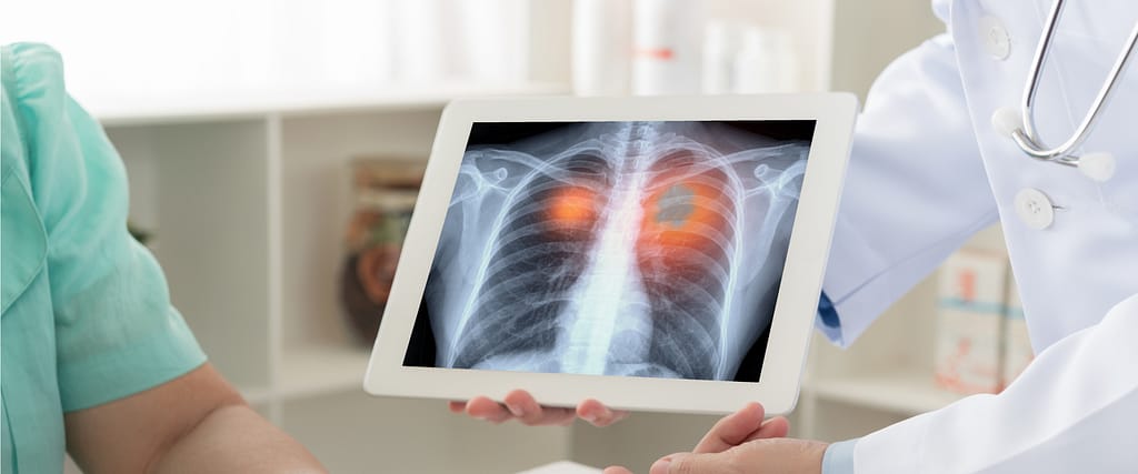 Rak płuc – diagnostyka, leczenie i prognozy (cz. 2) - Alivia Onkofundacja