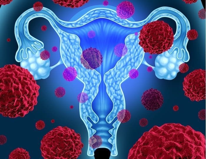 Objawy raka trzonu macicy (endometrium) - Alivia Onkofundacja